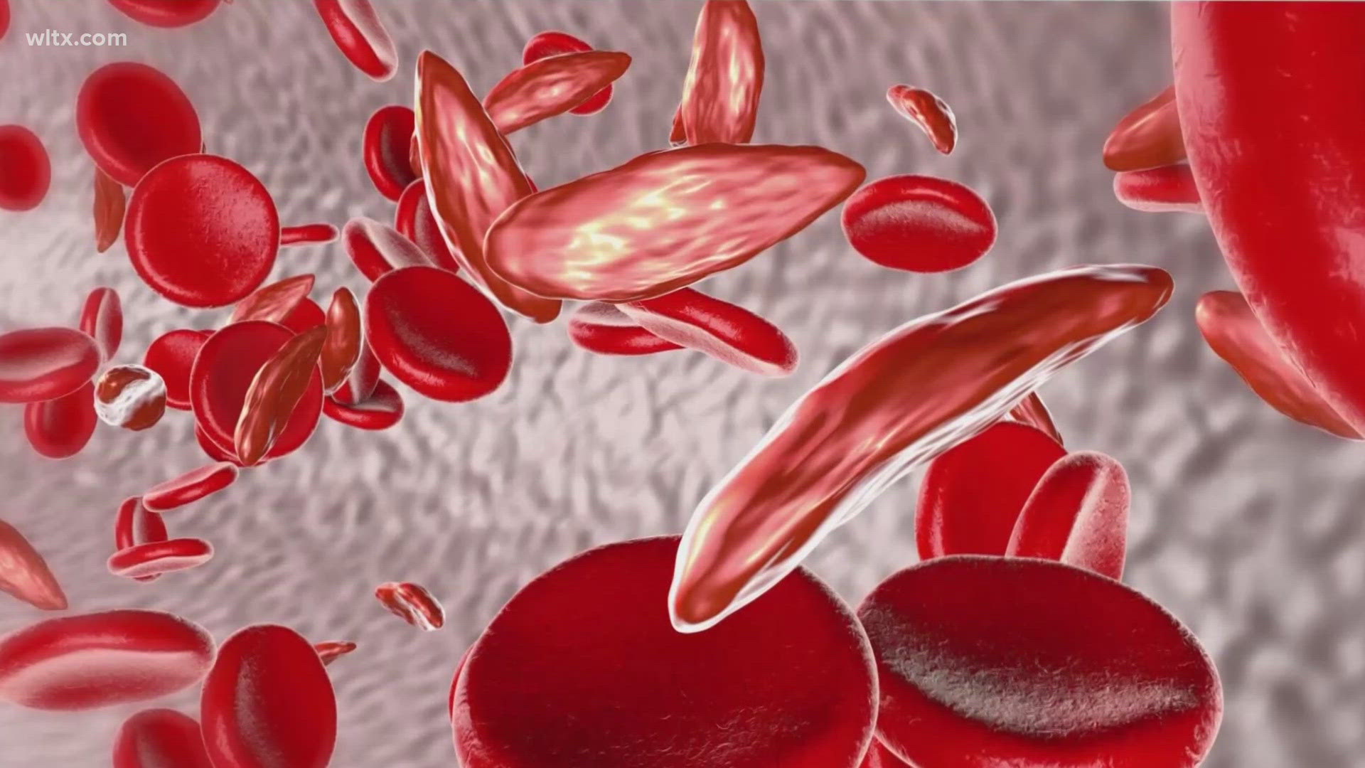 South Carolina DPH highlights sickle cell registry during awareness ...
