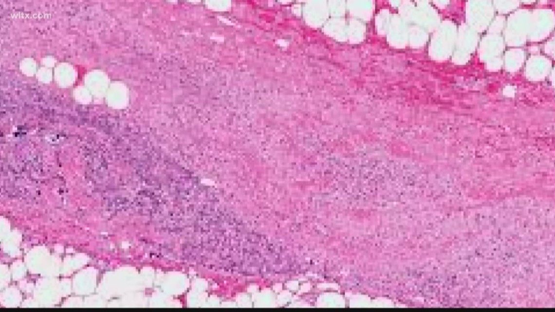 Things to know about flesh-eating diseases | wltx.com