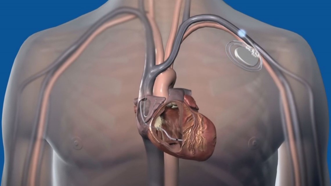 Lexington Medical Center: Heart Arrhythmia | wltx.com