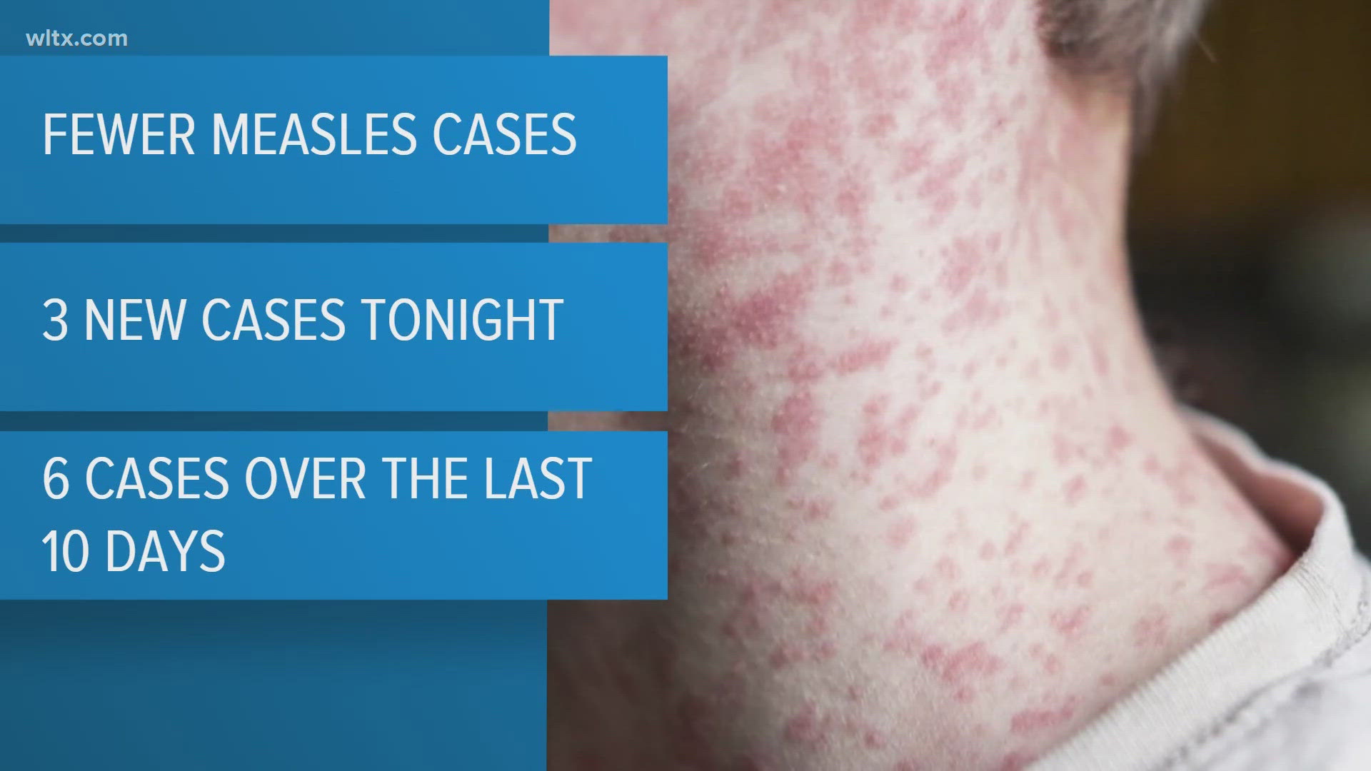 Measles cases in South Carolina almost at 1,000 | wltx.com