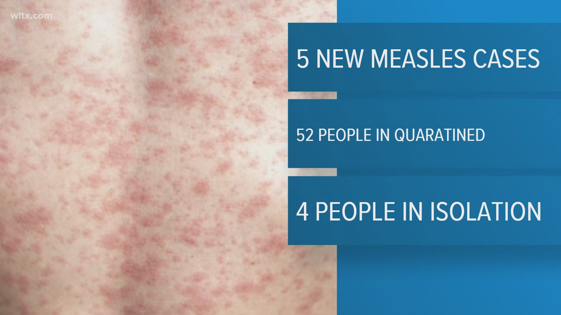 South Carolina measles outbreak grows to 990 cases, new exposure ...
