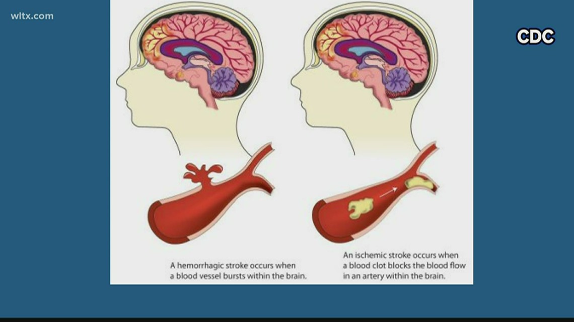 Some may be ignoring stokes, heart disease due to coronavirus | wltx.com