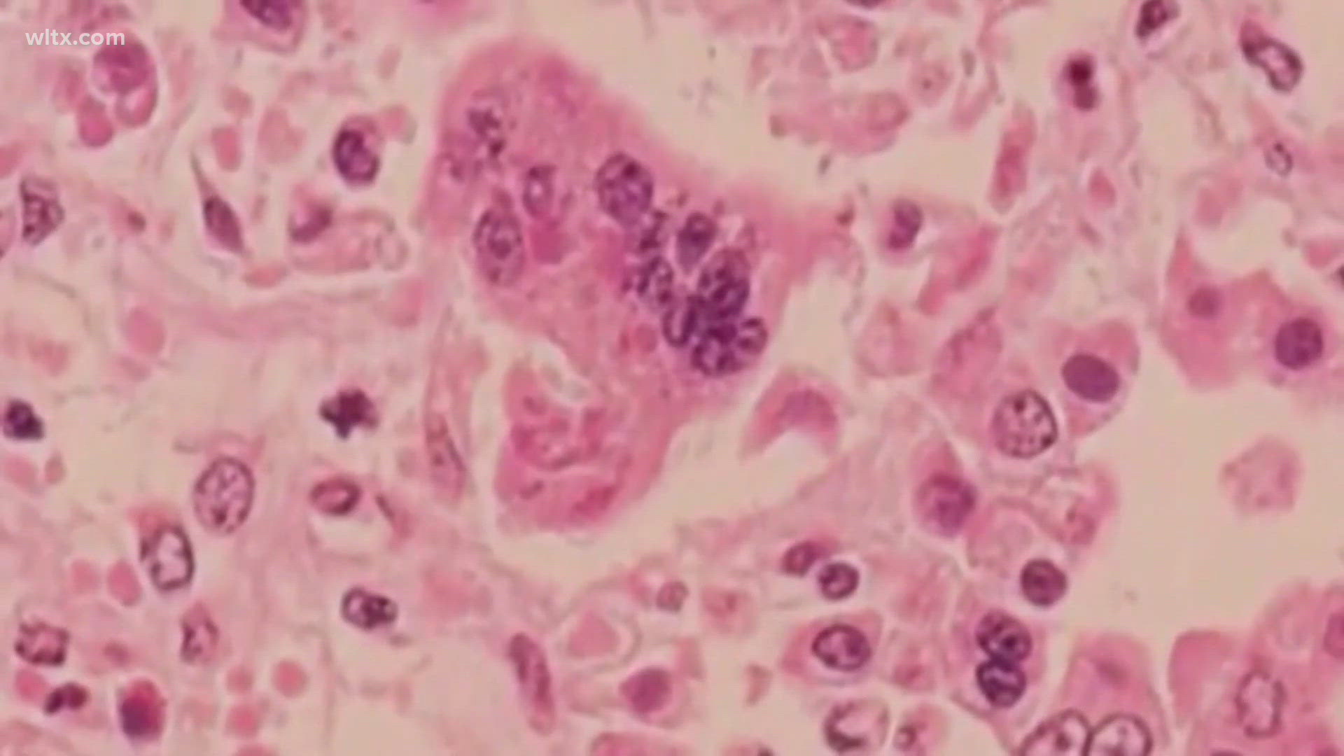 Third measles case in South Carolina confirmed | wltx.com