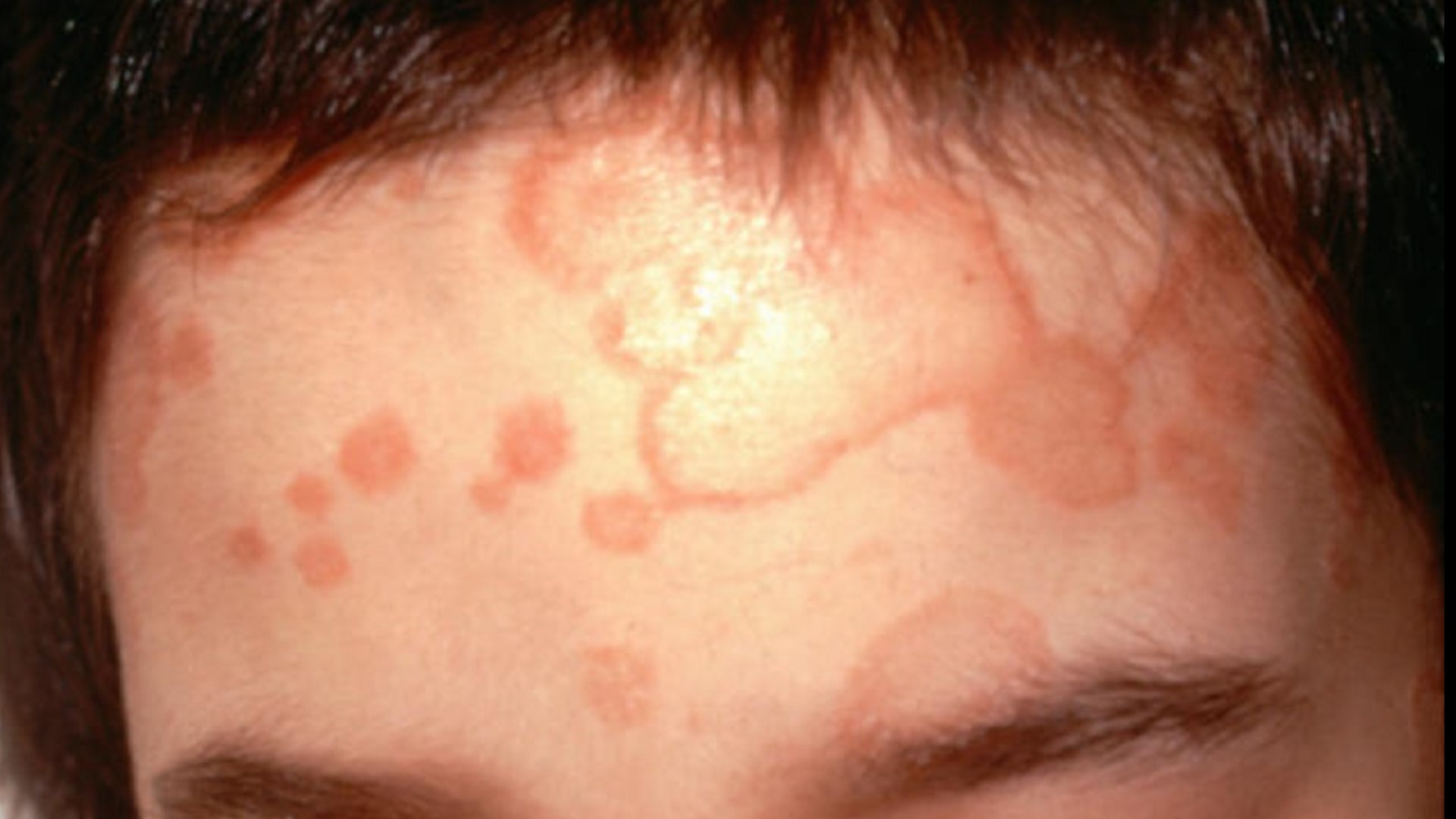 Treatment-resistant ringworm infections seen in U.S. | wltx.com