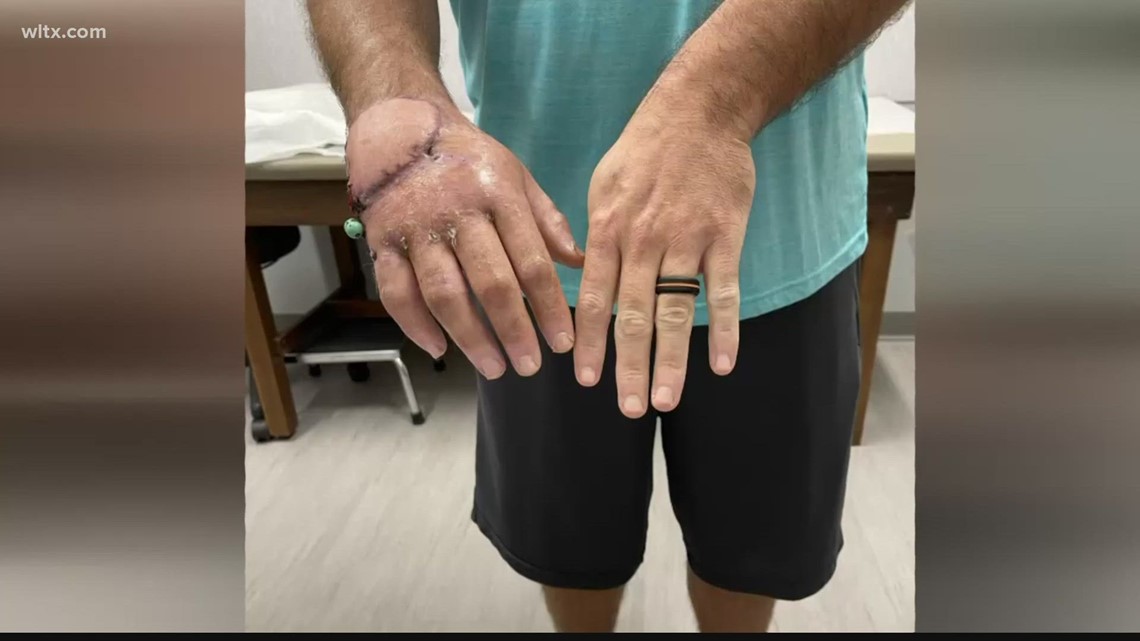 Man severely injured by firework malfunction warns others about ...