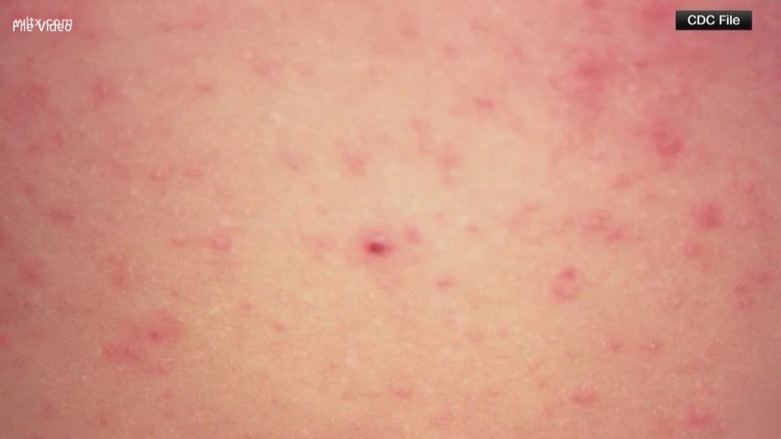 Measles outbreak continues in South Carolina | wltx.com