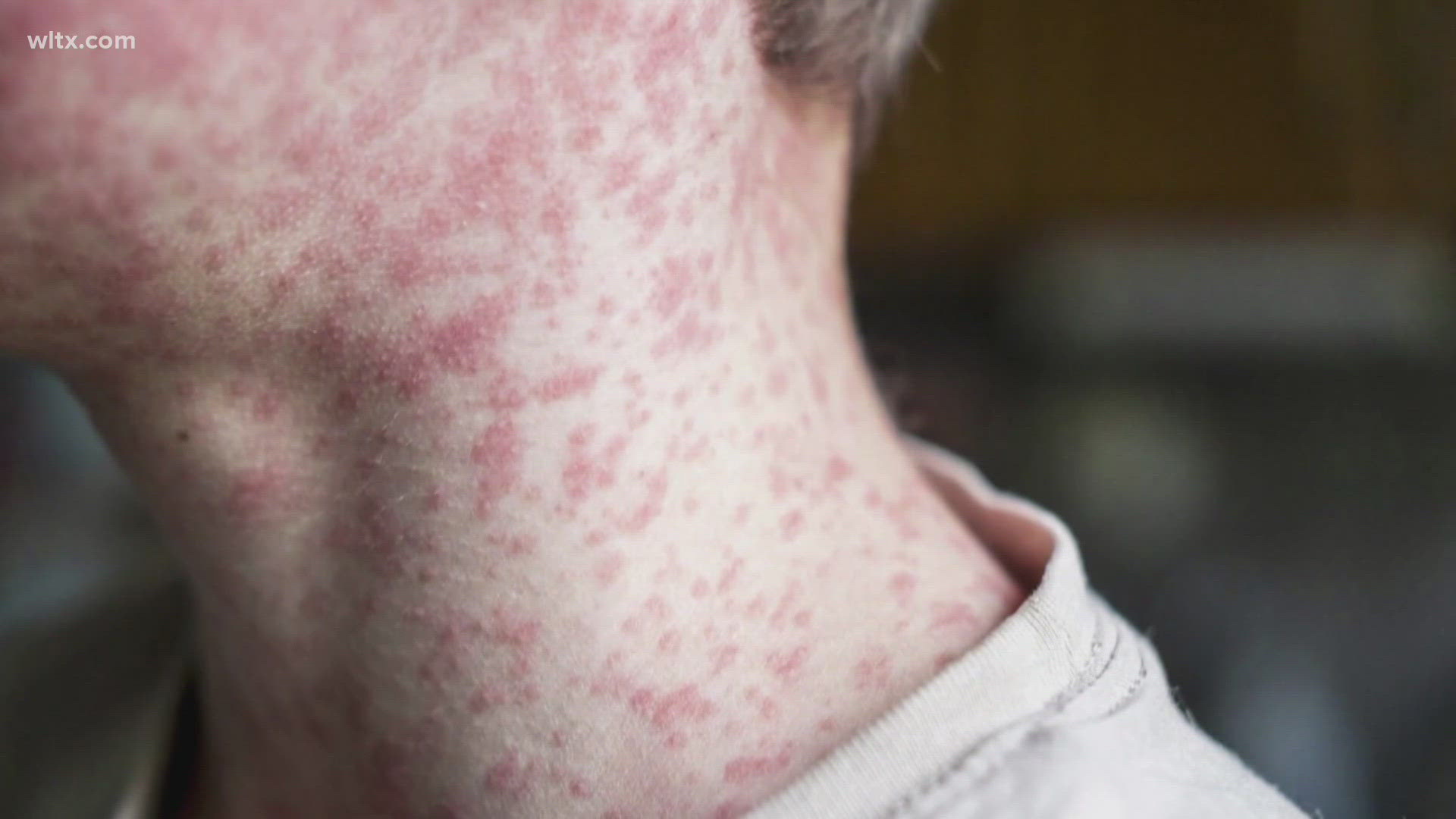 DPH reports nine new measles cases as Upstate outbreak grows to 185 in ...